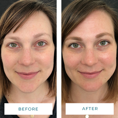 Cosmetic Acupuncture | Alternative to Botox - Healing InSight
